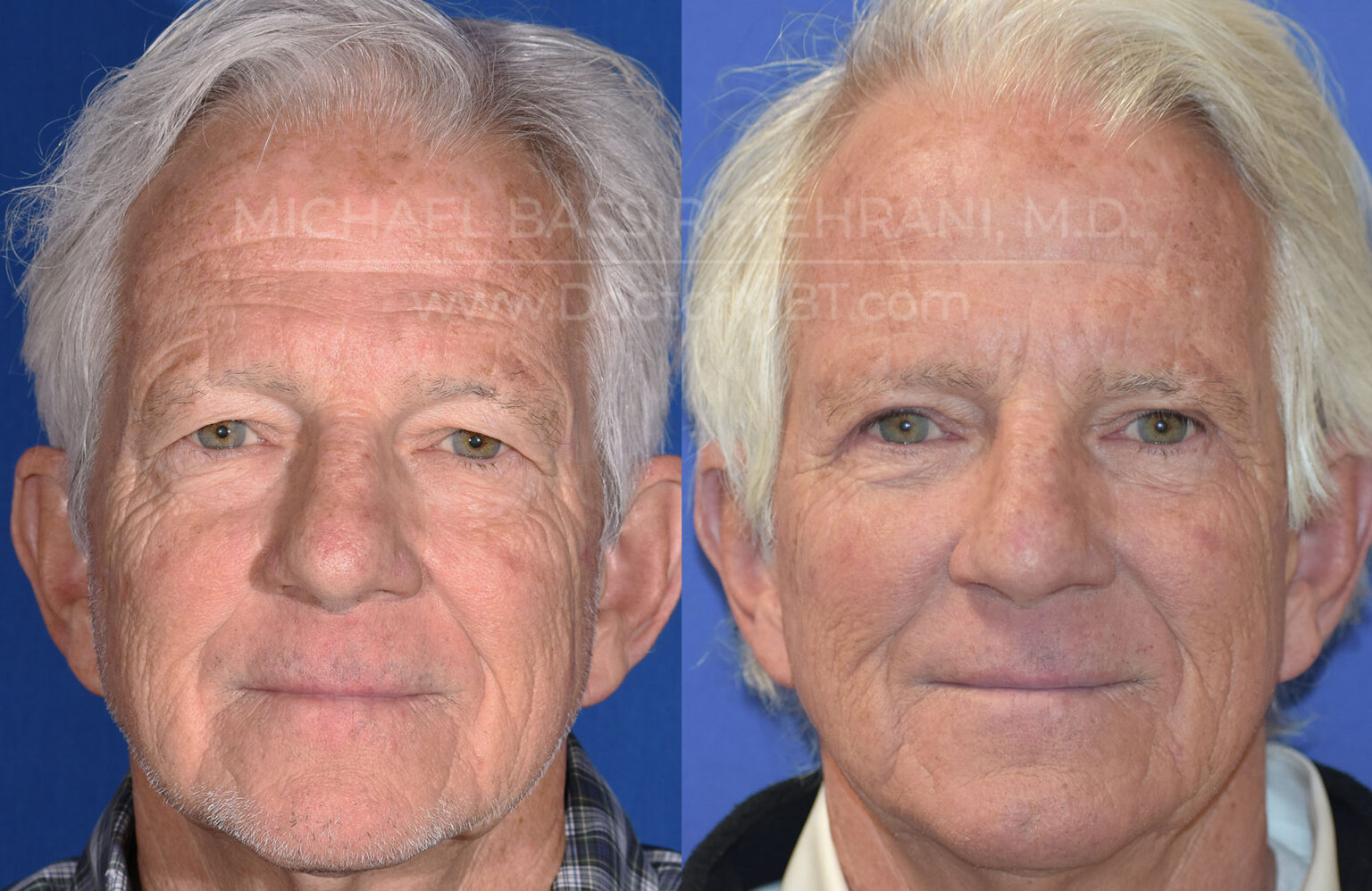 Blepharoplasty NYC | MBT Facial Plastic & Reconstructive Surgery