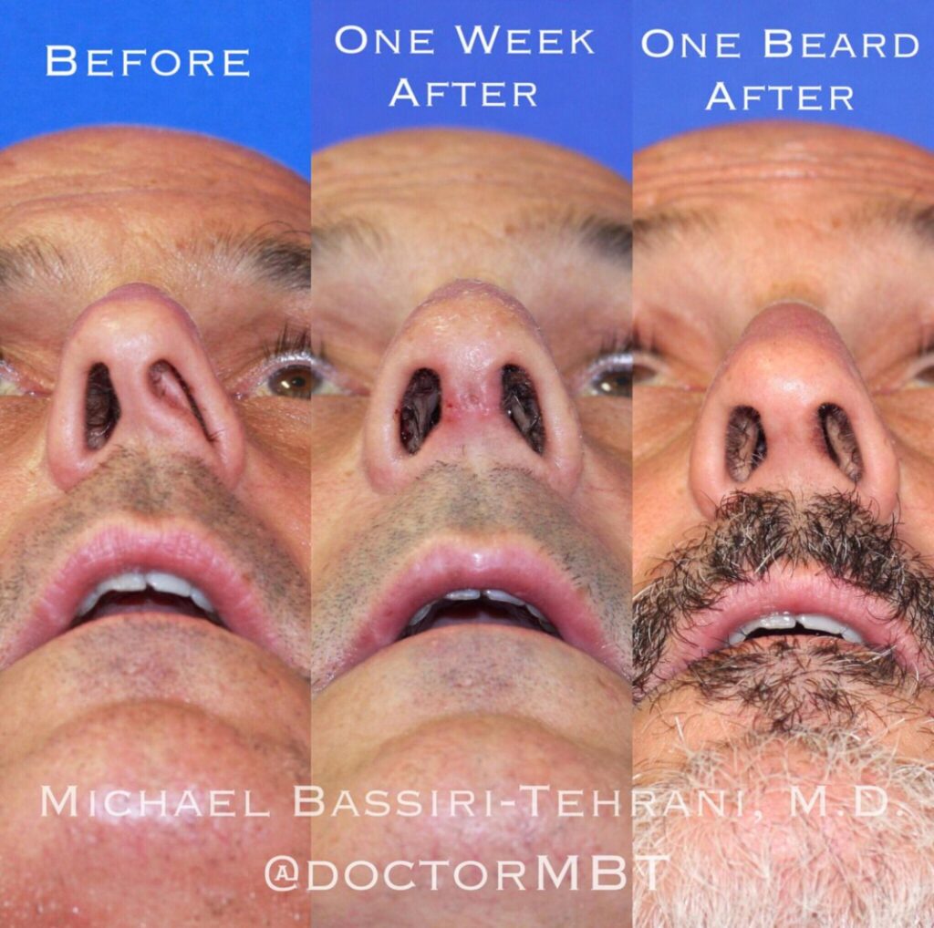 Functional Rhinoplasty NYC | MBT Facial Plastic & Reconstructive Surgery